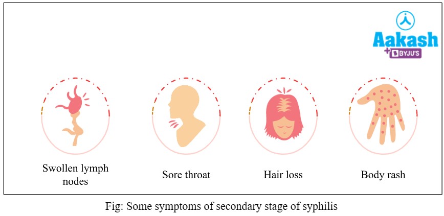 Syphilis: Causative Agent, Symptoms, Diagnosis, Treatment and ...