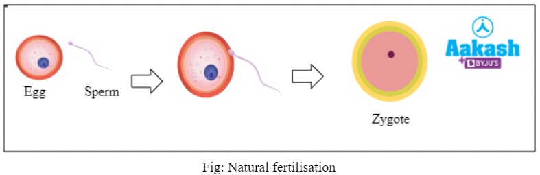 IVF: Meaning, Treatment, Steps & Significance | AESL