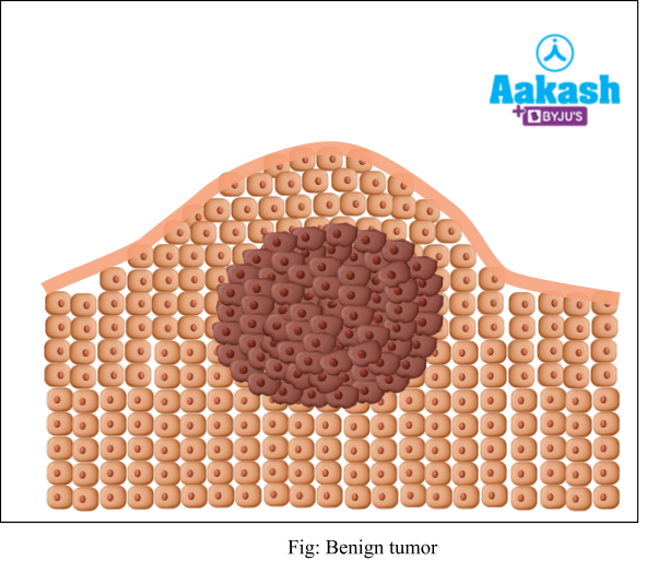 Cancer Causes, Treatment, Diagnosis, Types & Tumours Cells - Biology ...