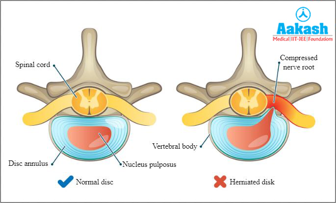 Spinal Cord: Structure, Anatomy, Functions, Injuries, Common Disorders ...