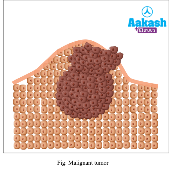 Cancer Causes, Treatment, Diagnosis, Types & Tumours Cells - Biology ...