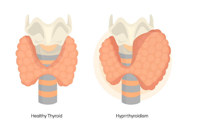 Hyperthyroidism in Women: Diagnosis, Symptoms & Causes | AESL