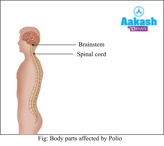Common Diseases in Humans: Types & Symptoms | AESL