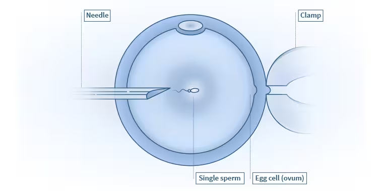 What is Assisted Reproductive Technology: Types and Advantages | AESL
