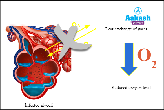 Common Causes of Respiratory Disorders System & Mountain Sickness | AESL