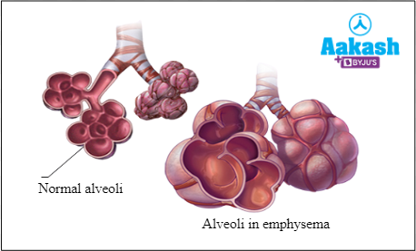 Common Causes of Respiratory Disorders System & Mountain Sickness | AESL