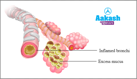 Common Causes of Respiratory Disorders System & Mountain Sickness | AESL