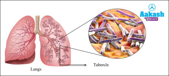 Human Diseases Types, Symptoms, Transmission & Treatment | AESL