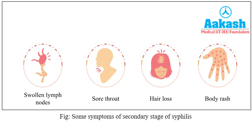 Syphilis: Causative Agent, Symptoms, Diagnosis, Treatment and ...